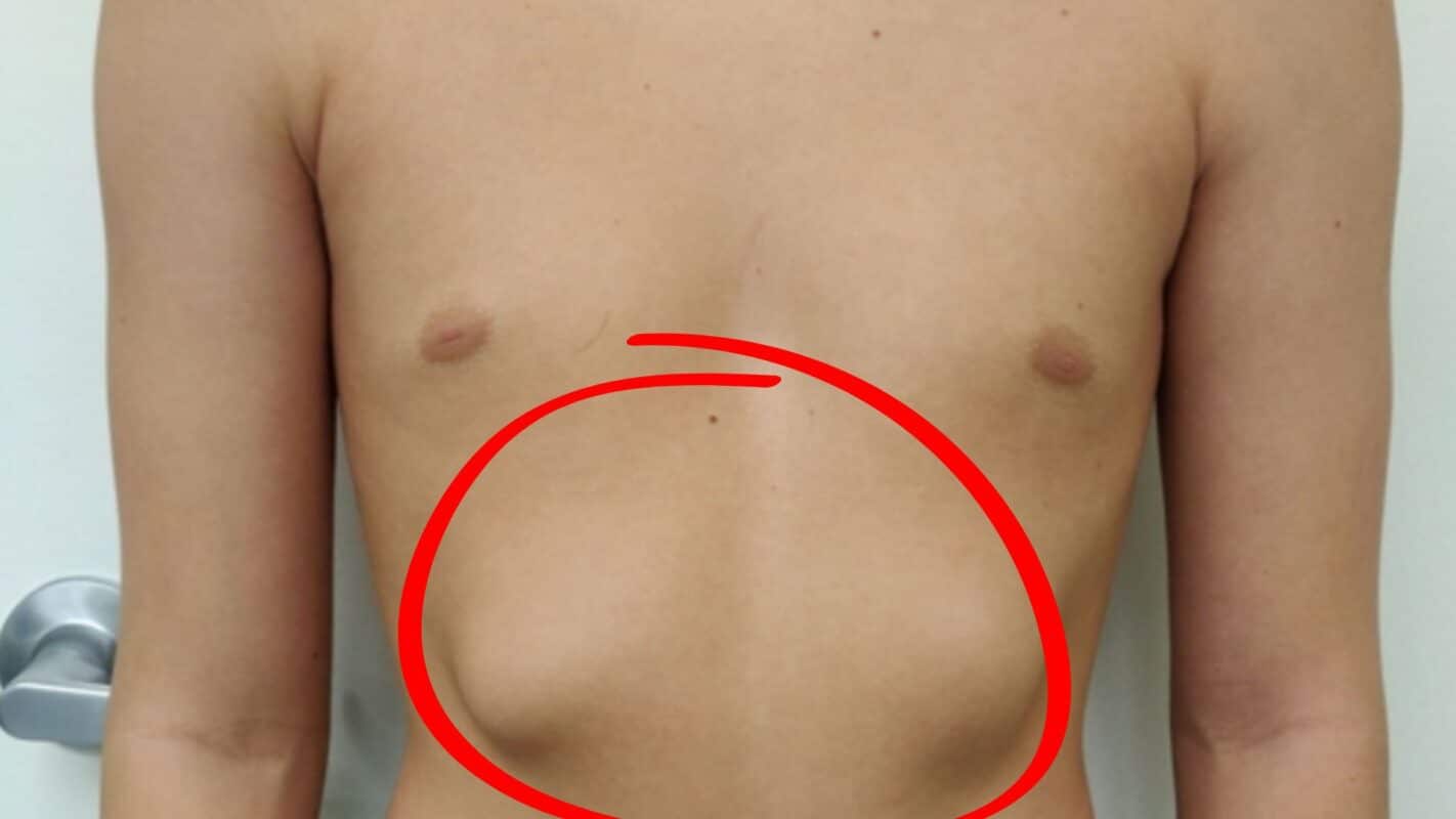 8 Effective Exercises to Reduce Flared Ribs and Enhance Posture - Theresa Reviews